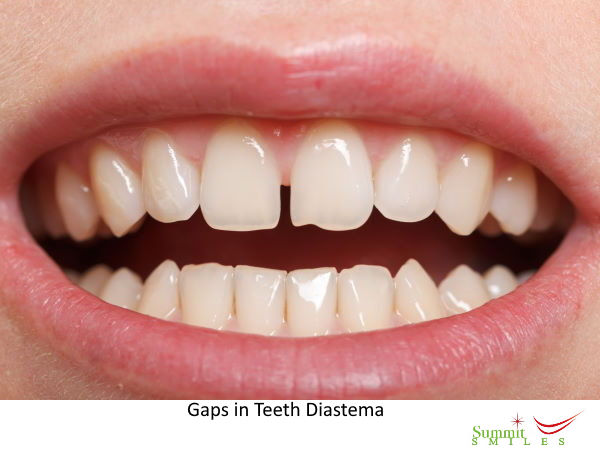 Diastema: What is Gaps Between Teeth? Causes, Treatment, Hereditary?