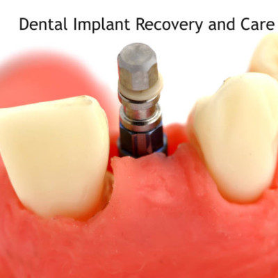 Dental Implant Repair